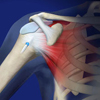shoulder - Plano Orthopedic & Sports Medicine Center